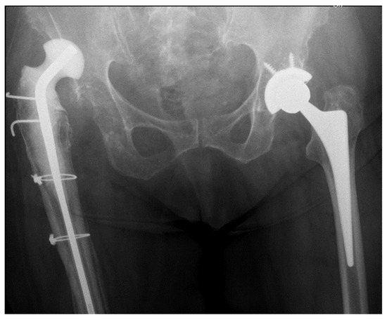 Gait Training with a Dislocated Hip Spacer: A Case Study and Literature ...
