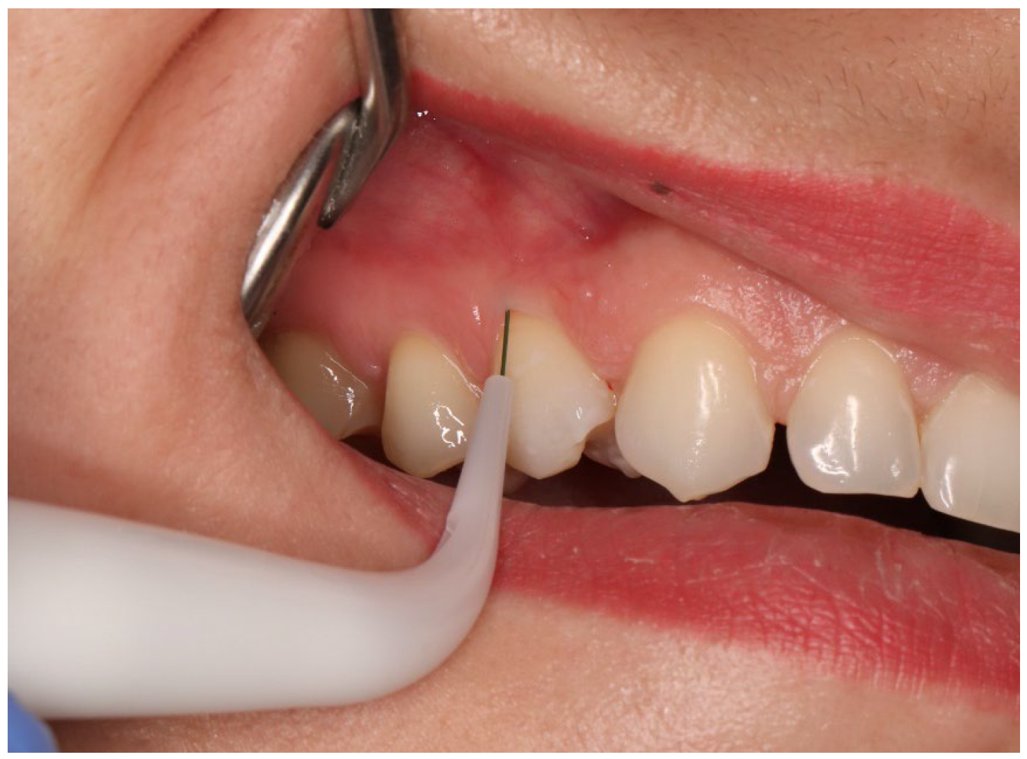 Clinical Efficacy of Er,Cr:YSGG Laser for Deepithelialization of Free ...