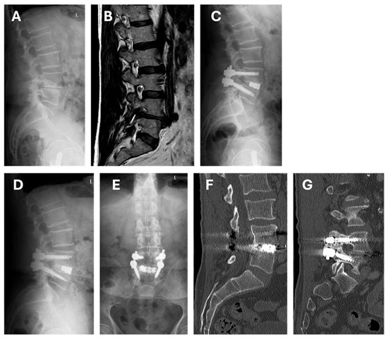 Transforaminal Lumbar Interbody Fusion (TLIF) with Expandable Banana ...