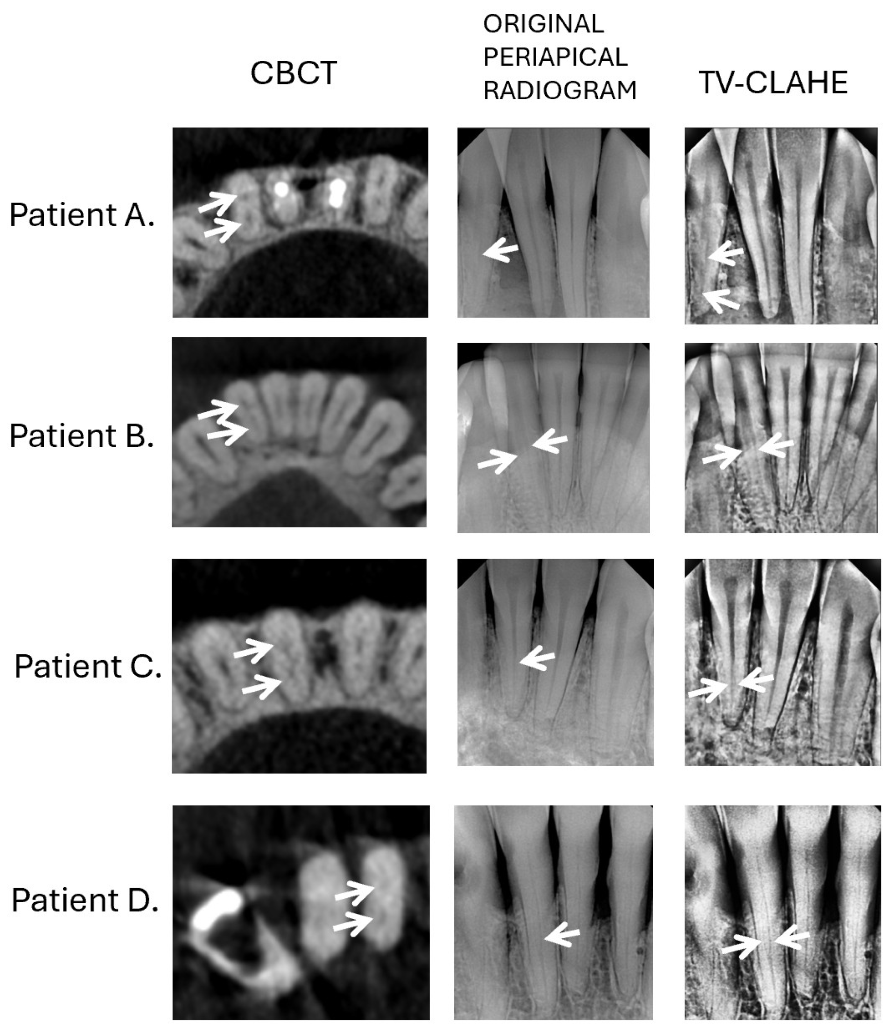 Improving Endodontic Radiograph Interpretation with TV-CLAHE for ...
