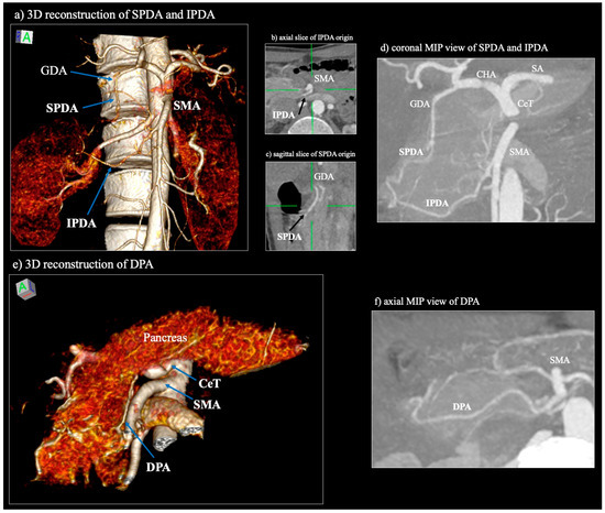 The Blood Supply of the Human Pancreas: Anatomical and Surgical ...