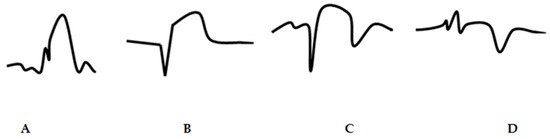 Proximal vs. Distal LAD Lesions in ST-Elevation Myocardial Infarction ...