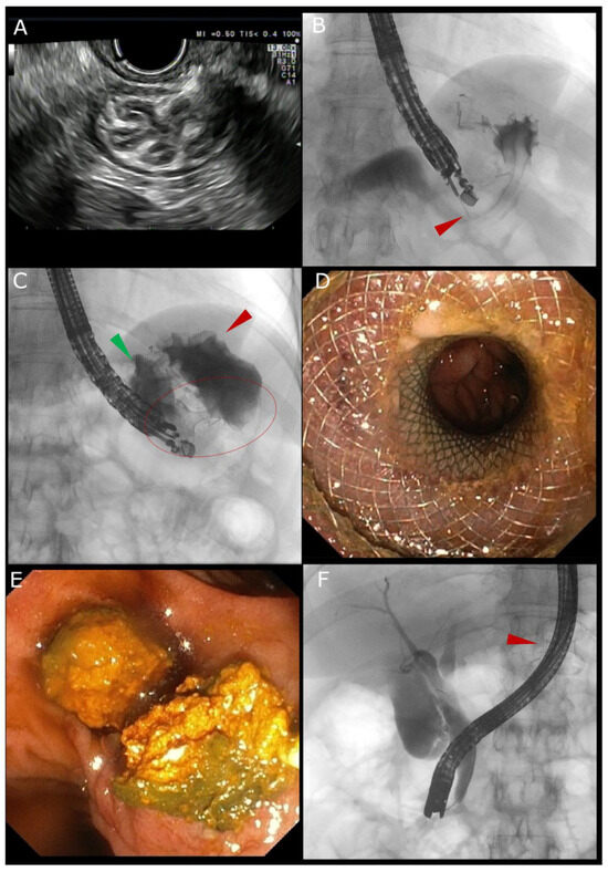 Endoscopic Ultrasound-Directed Transgastric Endoscopic Retrograde ...