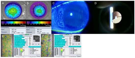 Resuturing a Dislocated Scleral-Fixated Intraocular Lens in Brown ...