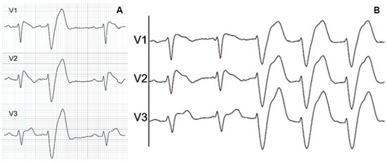 Uncommon and Accessory Electrocardiographic Findings in Brugada ...