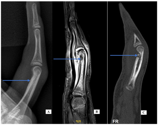 Enigmatic Cases of Finger Proximal Interphalangeal Joint Swelling: Case ...