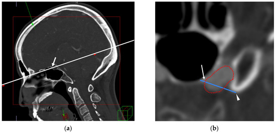 Prediction of Distal Dural Ring Location in Internal Carotid ...