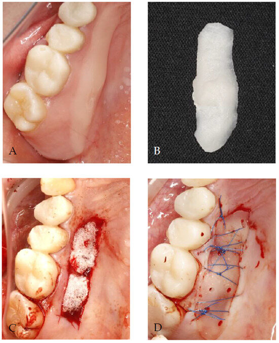 The Application of a Flowable Composite as a Method for Donor Site ...