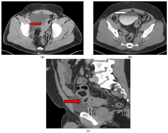 Comparison of Open Versus Minimally Invasive Repair of Colovesical ...