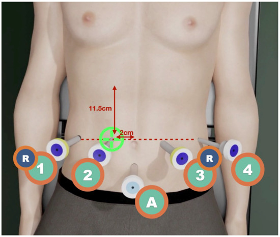 The Trunk of Henle and Belcher’s Vein: Important Venous Landmarks in ...