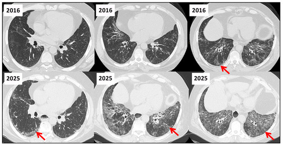 High-Resolution CT Findings in Interstitial Lung Disease Associated ...