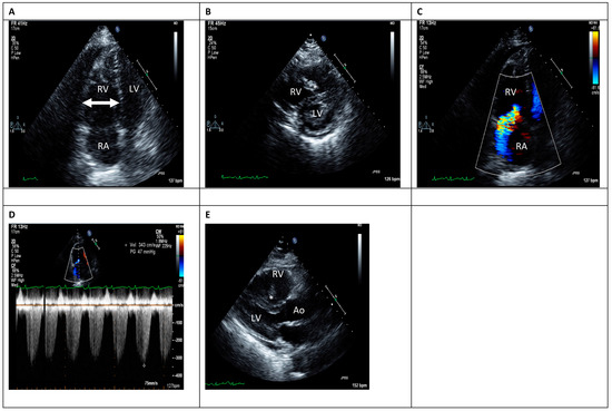 Intermediate-Risk Pulmonary Embolism: Patients’ Stratification ...