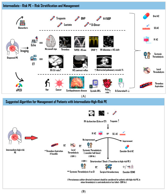 Intermediate-Risk Pulmonary Embolism: Patients’ Stratification ...