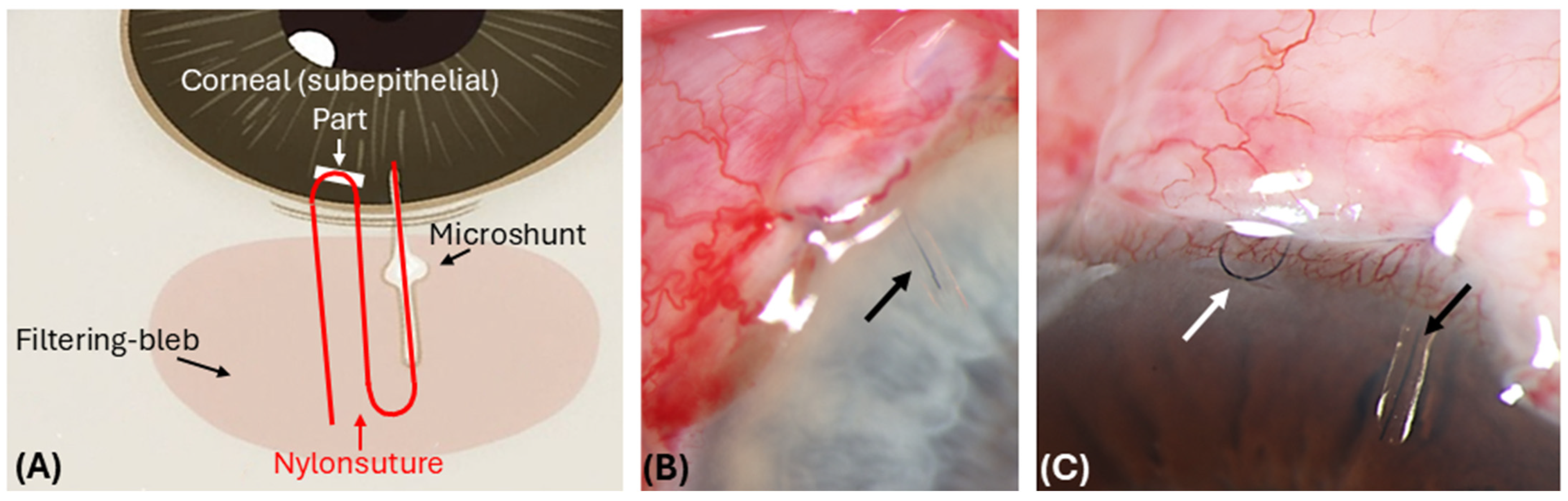 Intraluminal 10-0 Nylon Stenting in PRESERFLO™ MicroShunt Surgery for ...