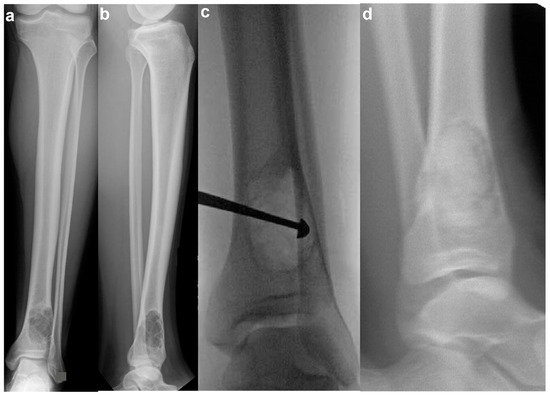 Non-Ossifying Fibromas: A 2025 Review
