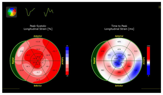 What Cardiologists Should Know About Amyloidosis