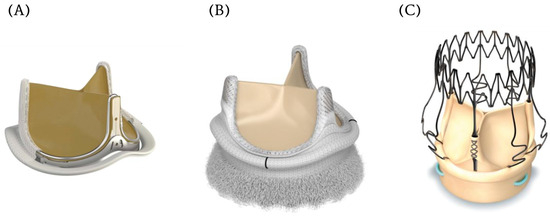 Redefining Aortic Valve Replacement: The Transition from Open Surgery ...