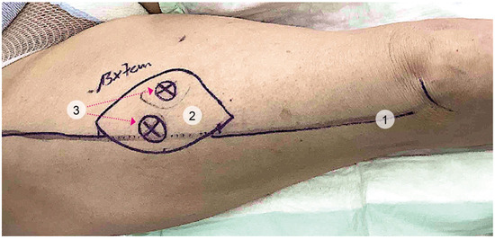 Microvascular ALT-Flap Reconstruction for Distal Forearm and Hand ...