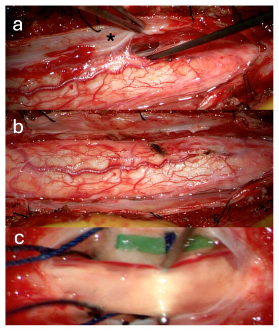 Tandem Detethering: A Novel One-Stage Approach Combining ...
