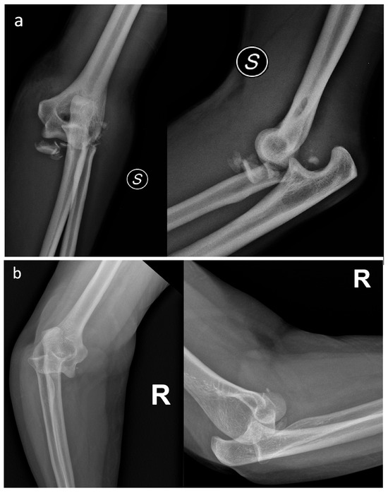 Radial Head Fractures: Is the Mason Classification Still Effective ...