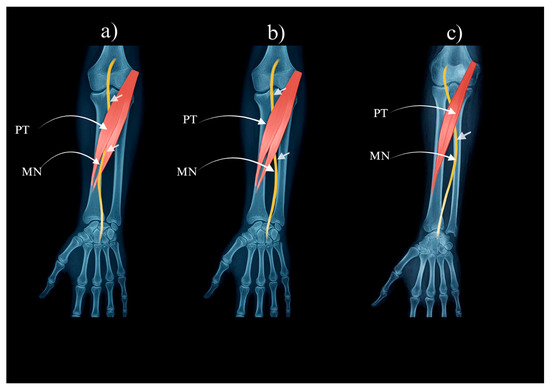 The Pronator Teres Muscle Revisited: Morphological Classification ...