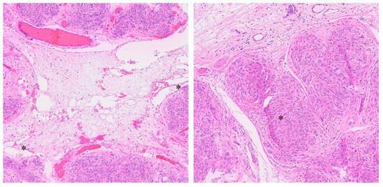 Multinodular Hydropic Leiomyoma in a 41-Year-Old Patient: A Case Report