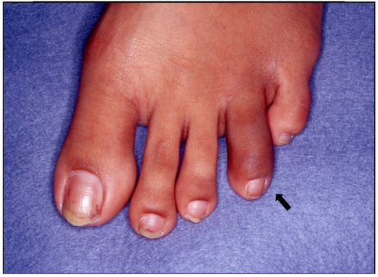 Psoriatic Arthritis: From Diagnosis to Treatment