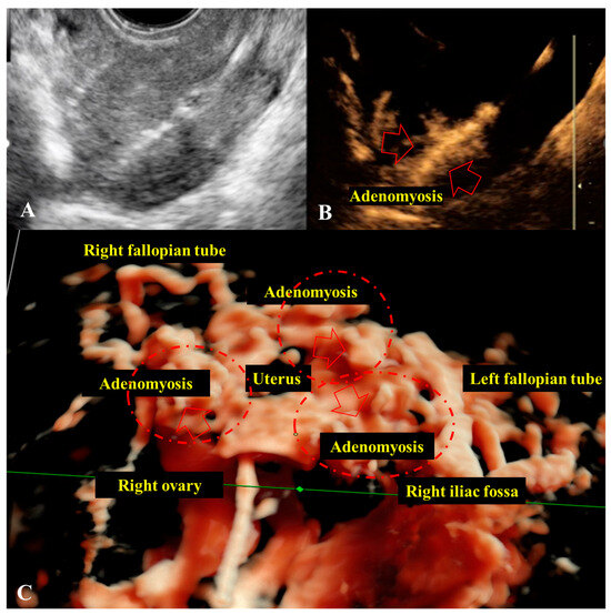 Adenomyosis-Modern Techniques for Ultrasound and Histo-Pathological ...