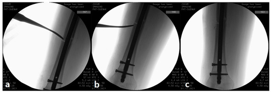 Decortication in the Surgical Management of Complete Atypical Femoral ...