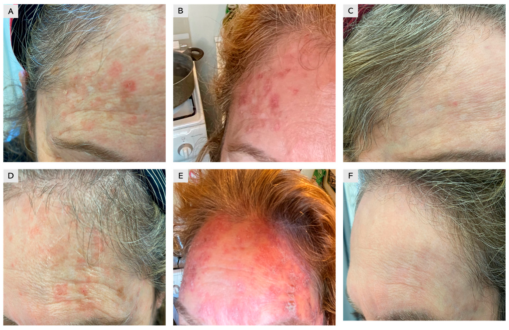 Efficacy of 4% 5-Fluorouracil Cream in the Treatment of Actinic ...
