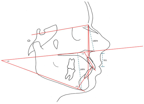 Geometric Morphometric Analysis of Hard and Soft Tissue in Class III ...
