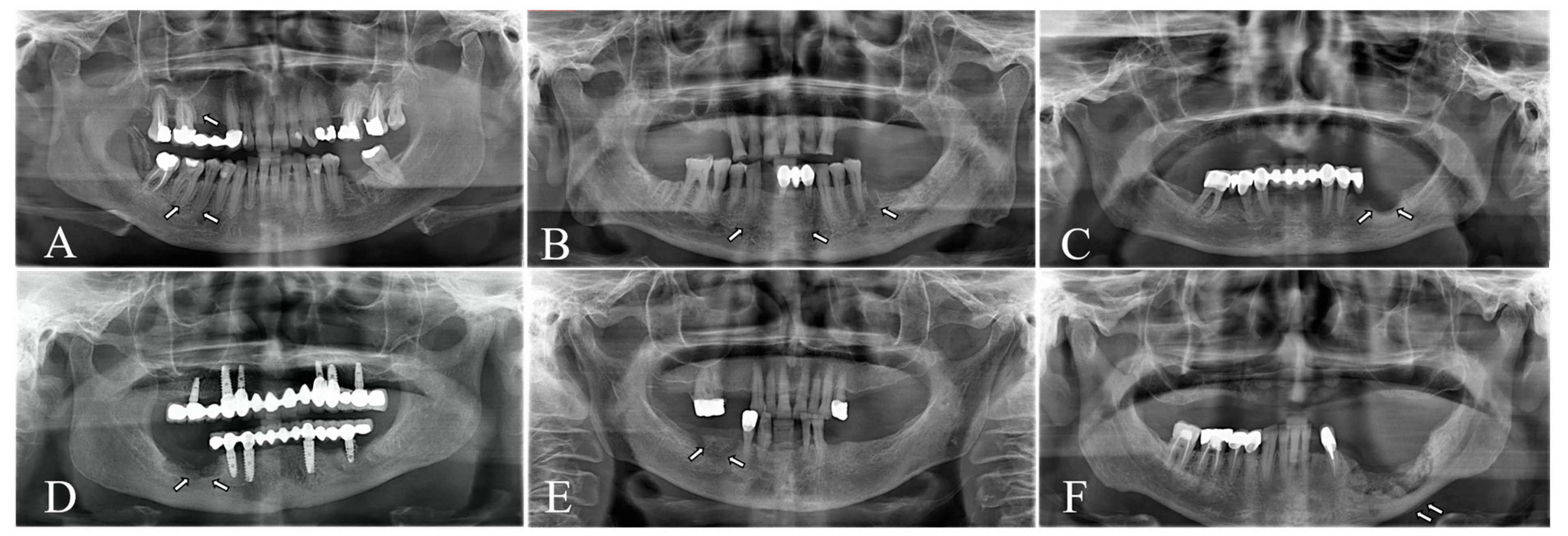 Radiographic Patterns and Clinical Correlates of Medication-Related ...