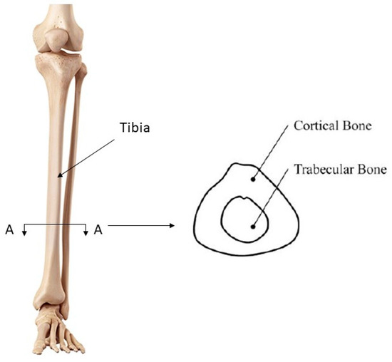 J. Compos. Sci. | Free Full-Text | Stress Analysis of Tibial Bone Using ...