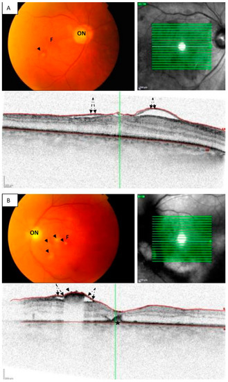 Bilateral Fungal Endophthalmitis: A Multidisciplinary Challenge