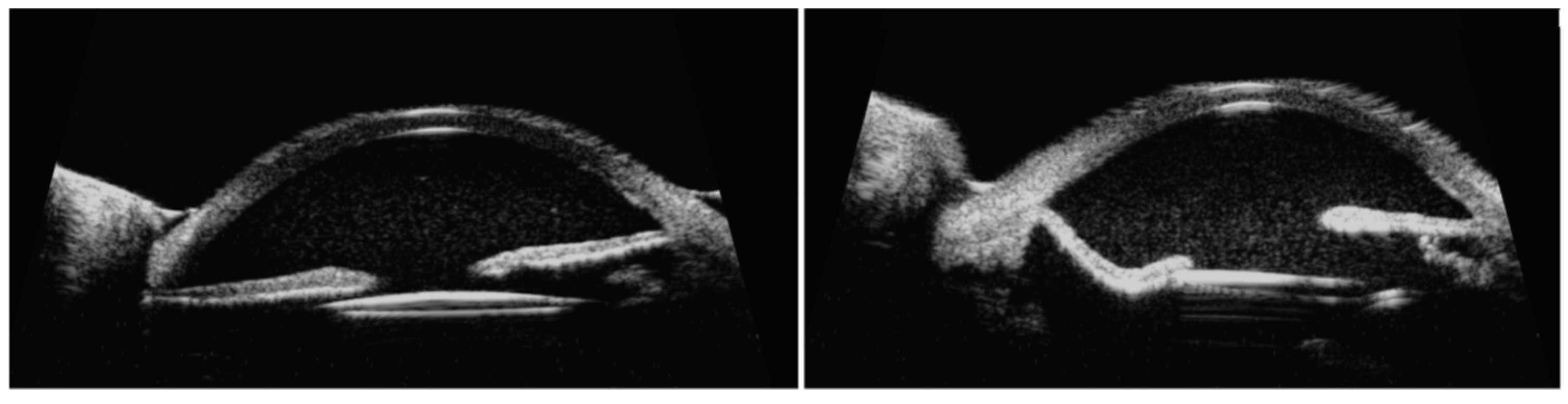 Recurrent Uveitis-Glaucoma-Hyphema Syndrome Due to Positional Pupillary ...