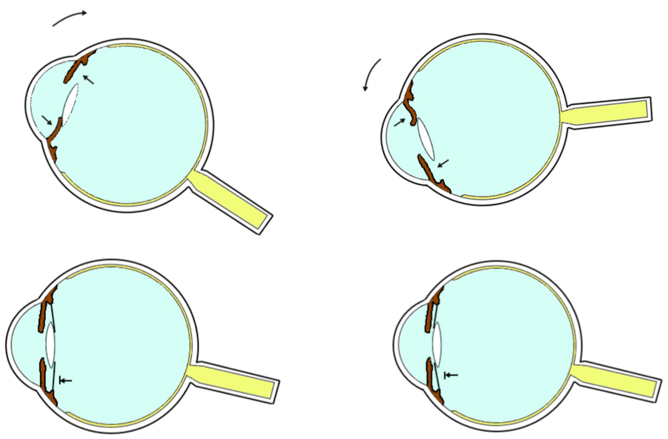 Recurrent Uveitis-Glaucoma-Hyphema Syndrome Due to Positional Pupillary ...