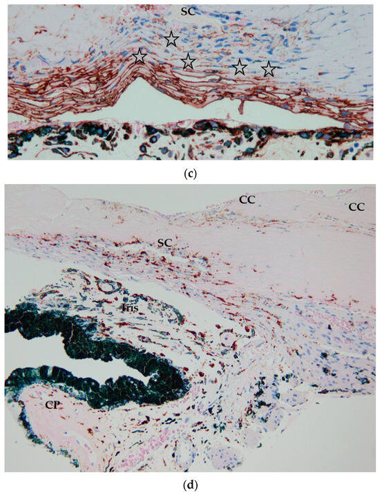 JCTO | Free Full-Text | A Case Report of Secondary Glaucoma in a ...