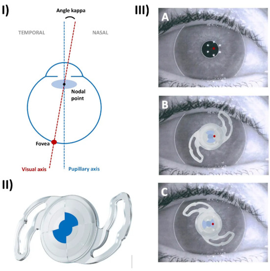 Presbyopia-Correcting Intraocular Lens with Butterfly-Shaped Central ...