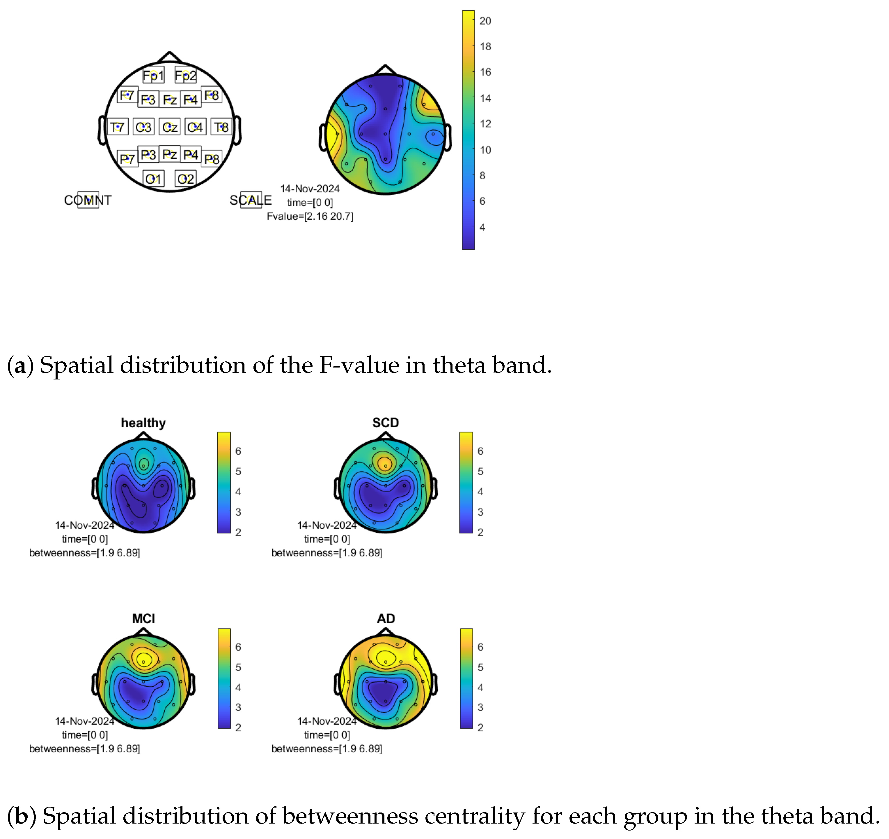 Exploring Functional Brain Networks in Alzheimer’s Disease Using ...