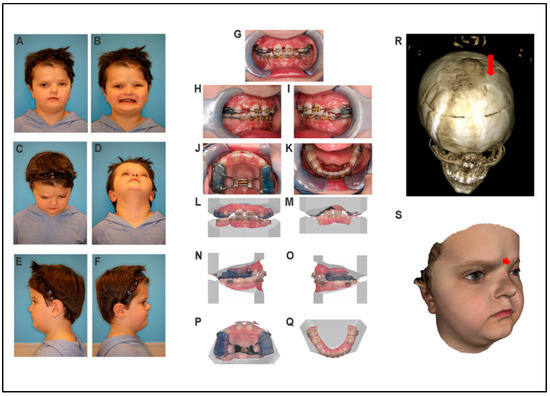 Quantitative Craniofacial Analysis and Generation of Human Induced ...