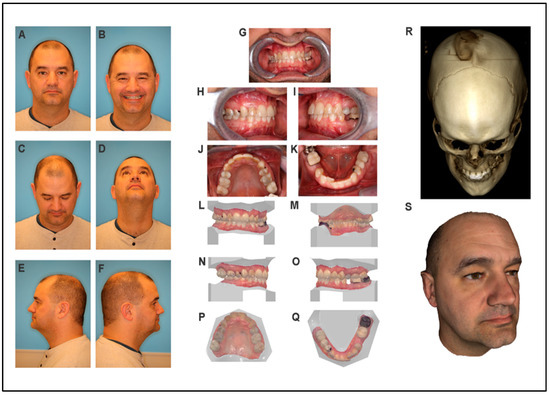 JDB | Special Issue : Craniofacial Genetics and Developmental Biology