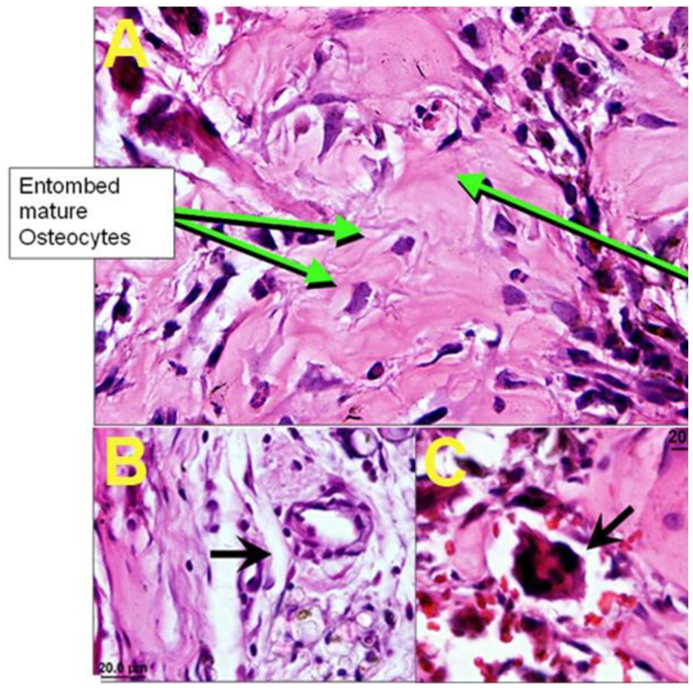 JFB | Free Full-Text | Multi-Composite Bioactive Osteogenic Sponges ...