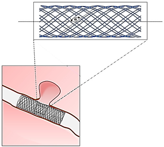 Medical Textiles as Vascular Implants and Their Success to Mimic ...