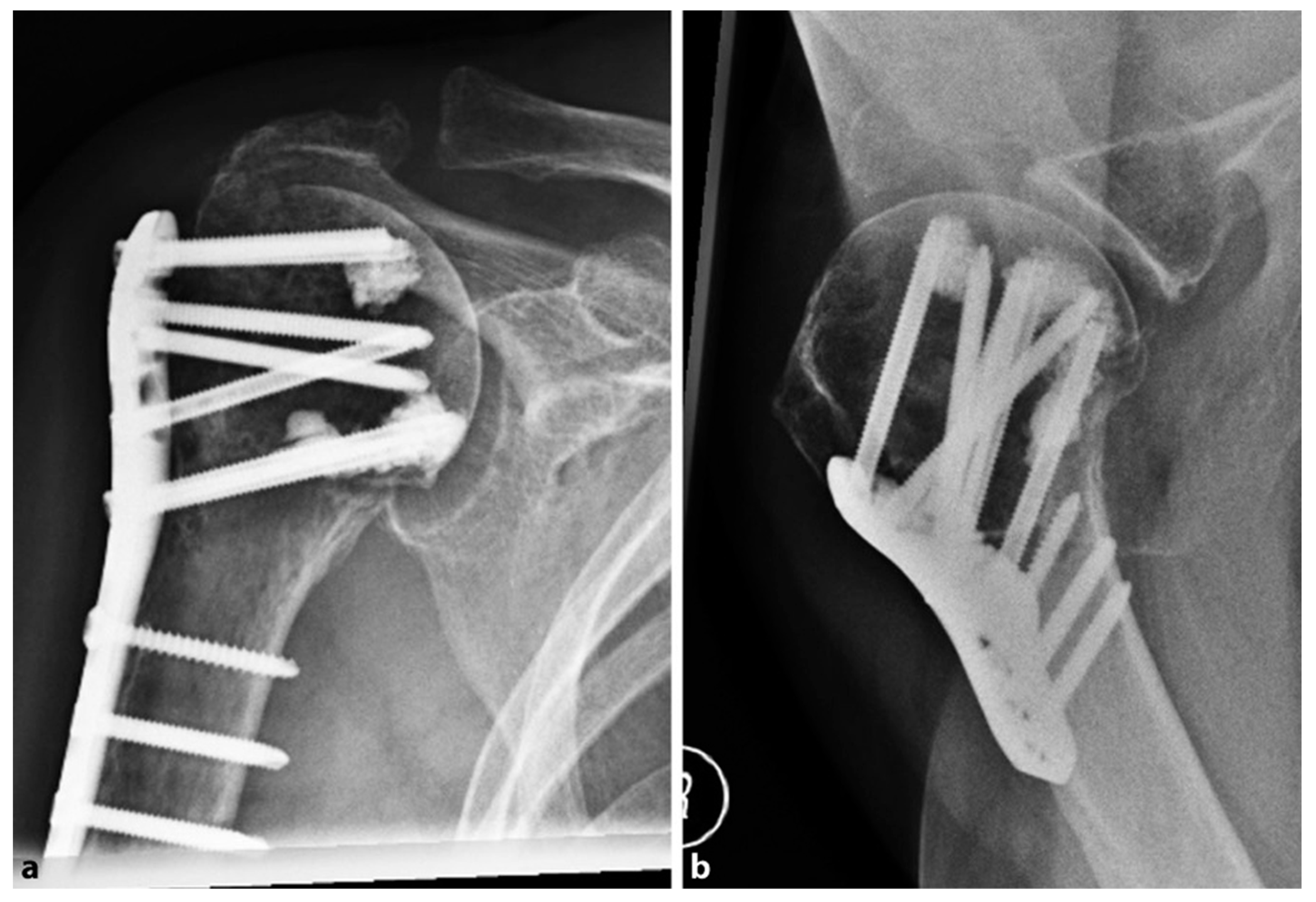 JFB | Free Full-Text | Synthetic Bone Substitutes and Mechanical ...