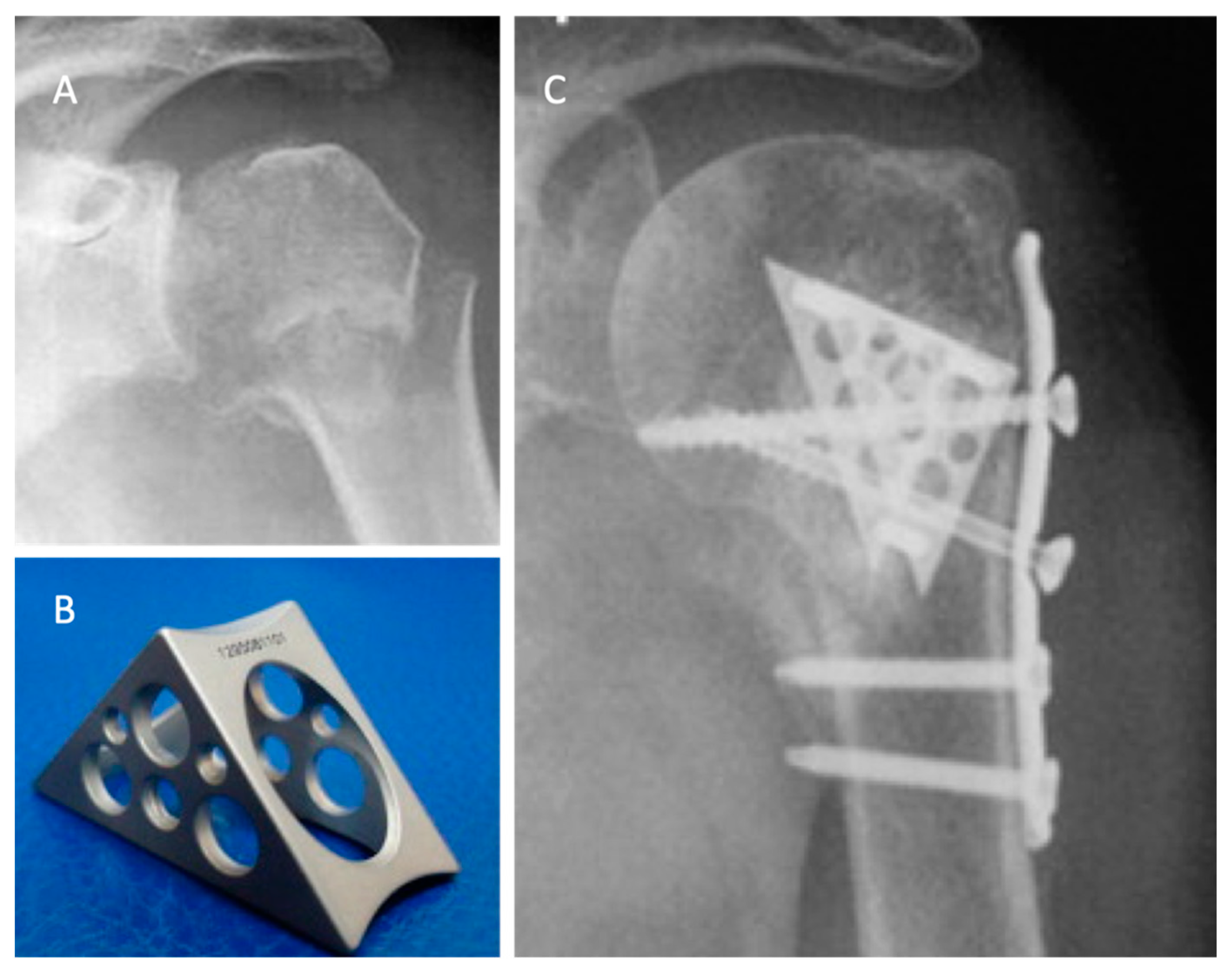 JFB | Free Full-Text | Synthetic Bone Substitutes and Mechanical ...