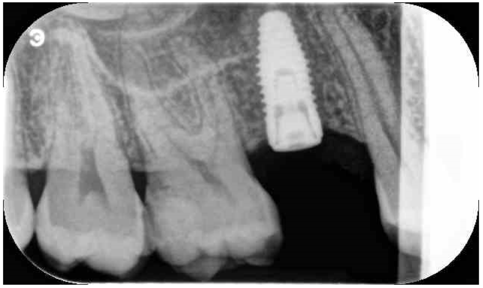 Implant Placement Following Crestal Sinus Lift with Sequential Drills ...