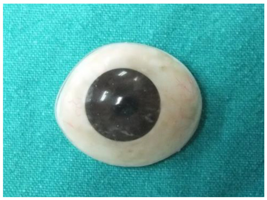 Magnification of Iris through Clear Acrylic Resin in Ocular Prosthesis