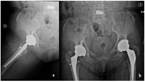 A Rare Case of Adverse Reaction to Metal Debris in a Ceramic-on-Ceramic ...