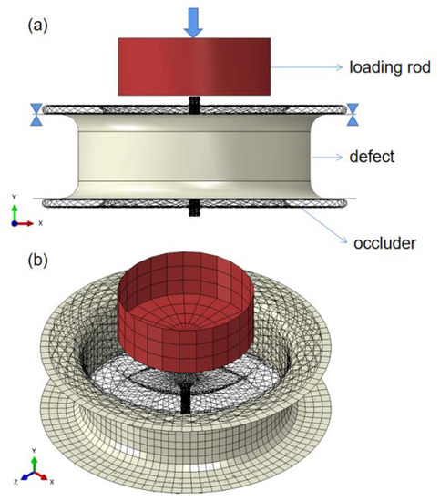 A Finite Element Investigation on Material and Design Parameters of Ventricular Septal Defect ...
