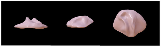 Obturator Manufacturing for Oronasal Fistula after Cleft Palate Repair ...